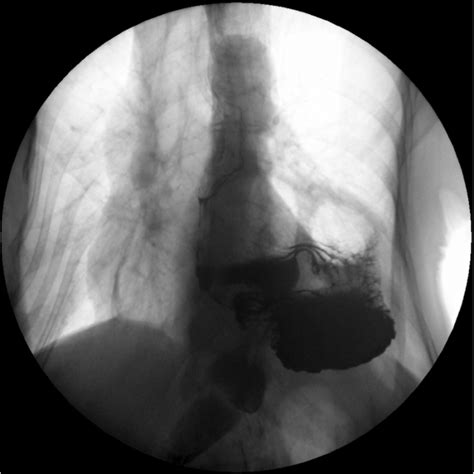 Mesentero Axial Gastric Volvulus Pacs
