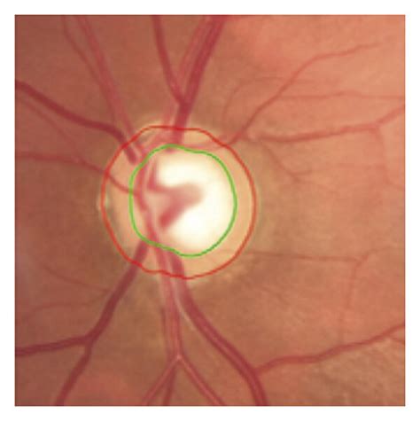 experimental results of the od and oc segmentation with severe