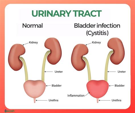 Sex Cause Bladder Infection When Urinary Tract Infections Keep Coming