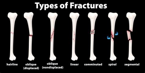 Fracture Wrist Symptoms Hairline At Ava Lazarev Blog