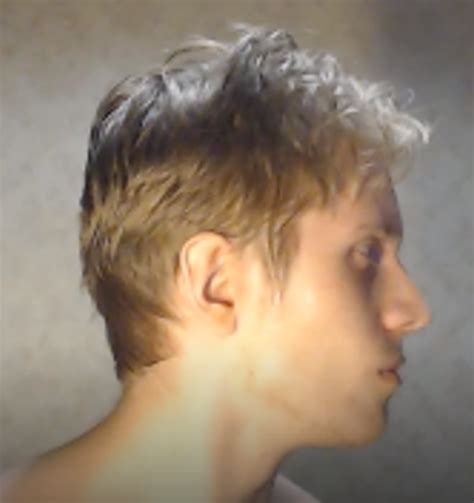 What Causes This Maxilla Curvature Forward Lower Flat Upper