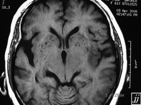 Left Parietal Convexity Cva Radiopaedia