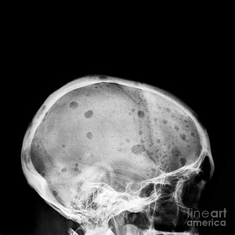 Myeloma Bone Scan Photograph By Science Photo Library Pixels