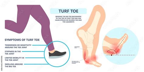 Turf Toe Gout Torn Tear Broken Bone Big Joint Sprain Sport Foot Distal