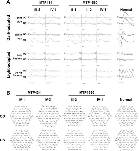 Full Field Electroretinography Fferg And Multifocal Erg Mferg Of
