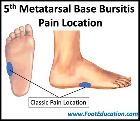 Fifth Metatarsal Base Bursitis Footeducation
