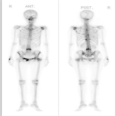 Bone Tumer Object Detection Model By University