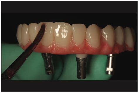 A Simplified Completely Digital Workflow For Full Arch Temporary Restorations Dentistry Today