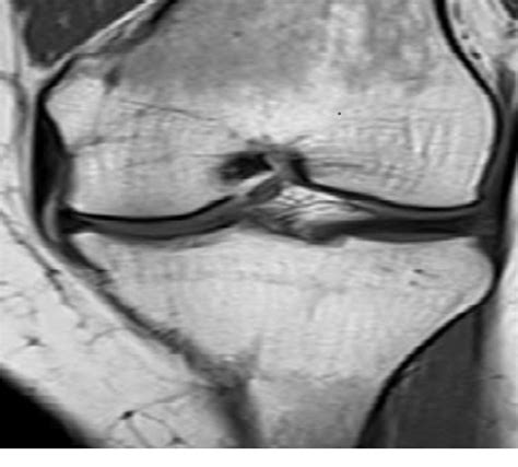 Figure 1 From Evaluation Of Bone Marrow Reconversion In Healthy Adults With Knee Mri Semantic