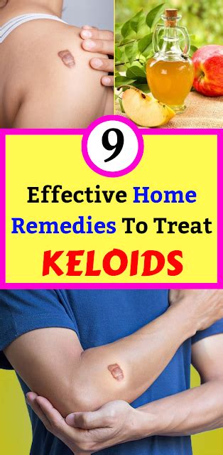 9 Natural Remedies For Keloids Healthy Lifestyle