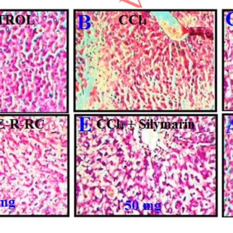 Percentage Reduction Of Serum Enzymes And Bilirubin Level In Treatment