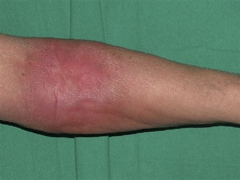 Erythematous Reaction After 5 Days From Extravasation Download