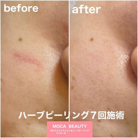 ハーブピーリングで傷痕の色素沈着 しみ もキレイに｜プロセルセラピーズ認定講師サロン～毛穴・薄毛特化mocabeauty～