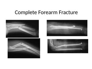 Pediatric Fracture And Its Complication Pptx