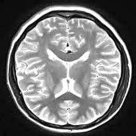 Brain Tumor Detection And Classification Instance Segmentation Model By