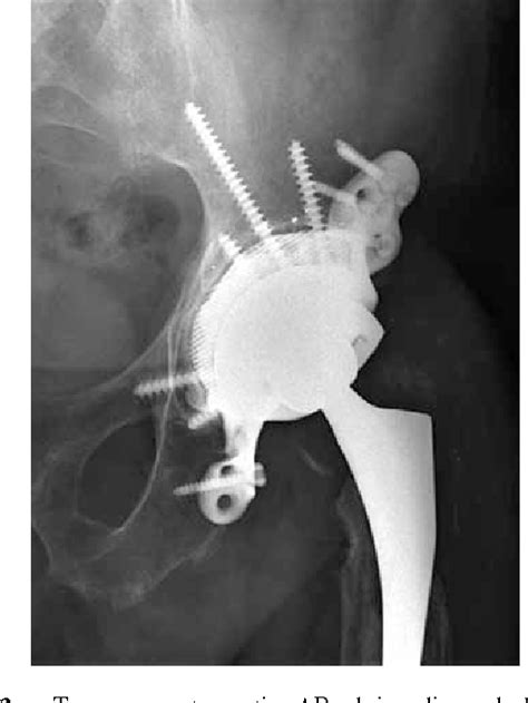 Figure 1 From A Modified Custom Made Triflanged Acetabular