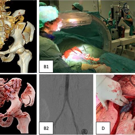 Patient 3 Initial Surgical Strategy And Control Of Bleeding A Ms 3d Ct Download Scientific