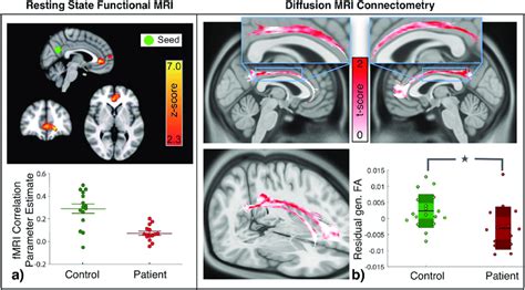 Microstructural White Matter Alterations In Default Mode Network Download Scientific Diagram
