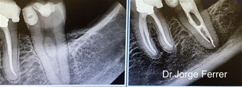 Jorge F On Linkedin Rct 3 7 C Shape Canals
