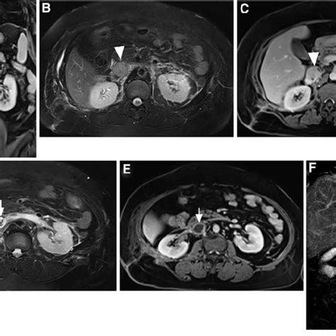 Pdf Primary Intraluminal Leiomyosarcoma Of The Inferior Vena Cava