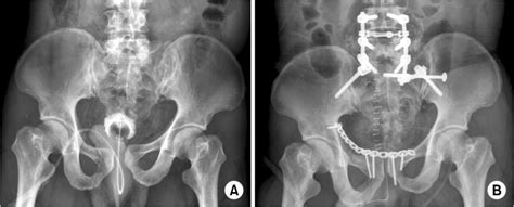A Initial Pelvis Antero Posterior Image Of A 47year Old Male Showing