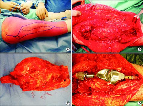 A Intraoperative Picture Showing The Wide Fusiform Skin Incision