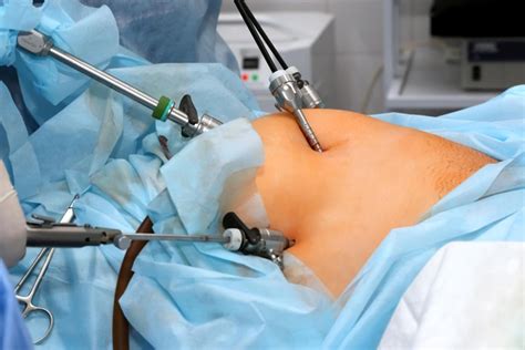 10 Things To Know About Laparoscopic Inguinal Hernia Repair