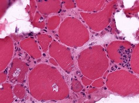 Miositis Wikipedia Bahasa Indonesia Ensiklopedia Bebas