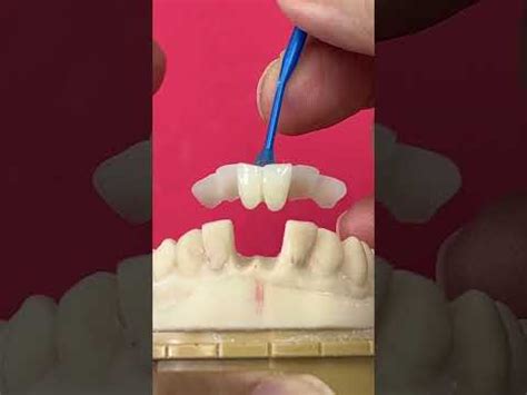 What Is The Code For Sectioning A Dental Bridge