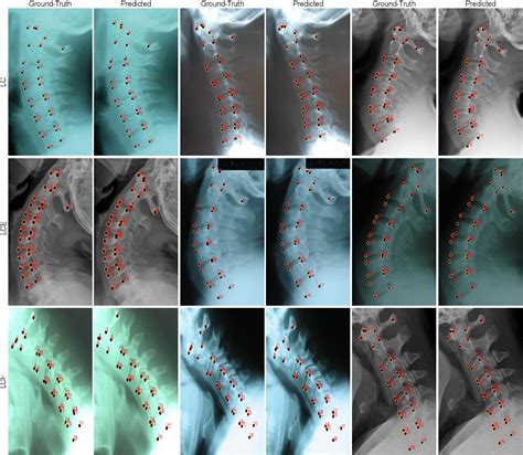 Figure 1 From Sagittal Cervical Spine Landmark Point Detection In X Ray Using Deep Convolutional