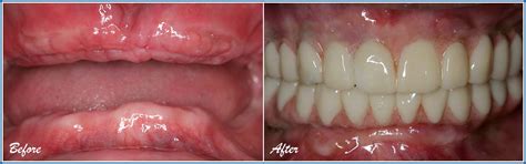 Affordable Dentures And Implants Affordable Dentures Cost Effective