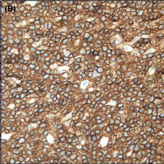 Histology And Immunophenotype Of Diffuse Large Bcell Lymphoma Diffuse