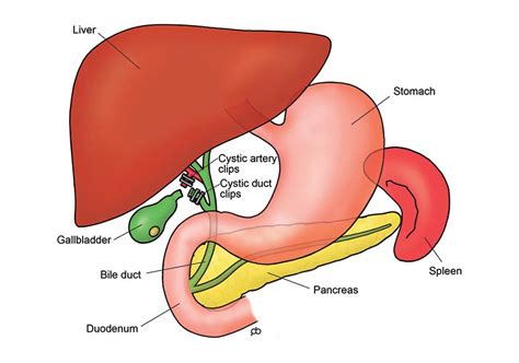 Abeezar Sarela Gallstones Laparoscopic Cholecystectomy