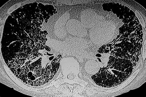 Sle Dramatically Increases Lung Disease Risk Aussie Data