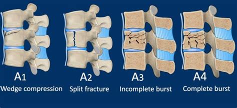The Radiology Assistant Ao Spine Classification Of Thoracolumbar