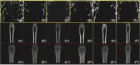 Screenshots Of Two‐and Three‐dimensional Profiles Of Bone Trabecular