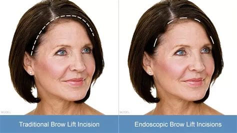 What Is An Eyebrow Lift Cost Alternatives Sarah Khayat Md