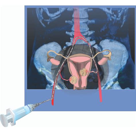 Uterine Fibroid Embolization Blue Rock Medical