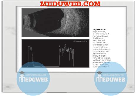 Normal And Abnormal B Scan Meduweb