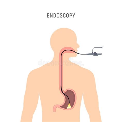 Endoscopy Stomach Anatomy Equipment Vector Illustration Esophagus