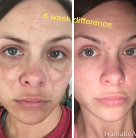 Differin Dark Spot Correcting Serum Onlybilla
