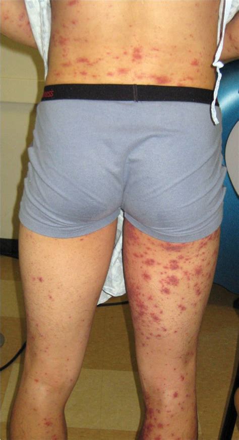 Vasculitis And Hypersensitivity Plastic Surgery Key