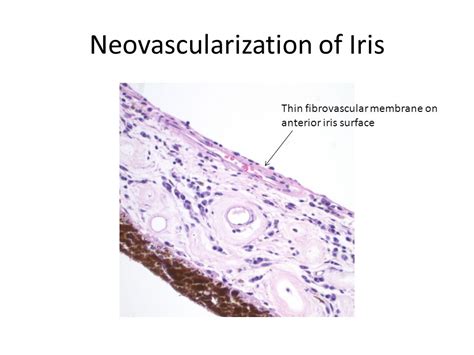 Neovascularization Of Iris