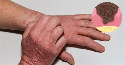 Plaque Psoriasis Treatments Doctors Wont Tell You About Trendseeker