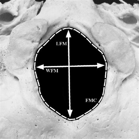 Foramen Magnum Measurements Lfm Maximum Length Wfm Maximum Width