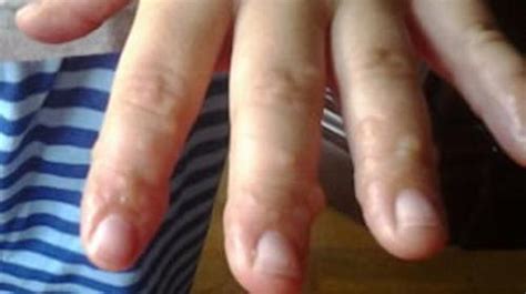 Hard Lumps On Your Finger Joints Beneath The Skin