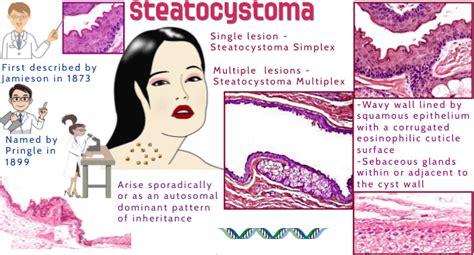 Steatocystoma Multiplex Histology