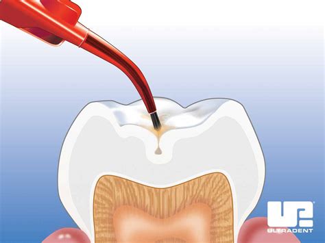 Ultradent Ultraseal Xt Hydro Sealant Clinical Research Dental