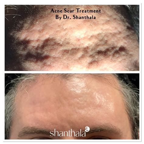 Acne Scars Treatment Latest Solution For Acne Scars Subcision And