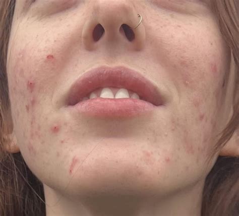 4 Months On Accutane Vs 6 Months On Accutane Raccutane